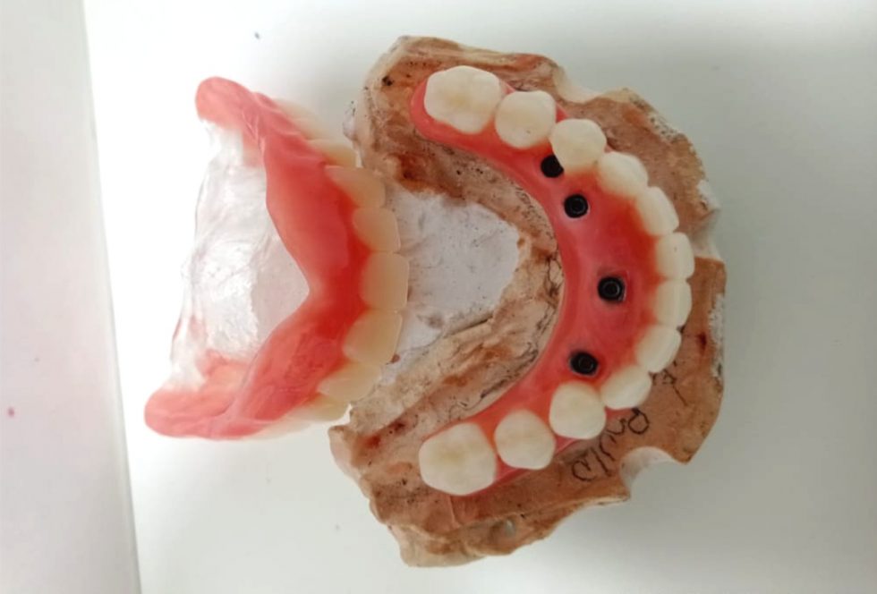 Principais benefícios dos implantes dentários | Fácil Implantes Principais benefícios dos implantes dentários | Fácil Implantes